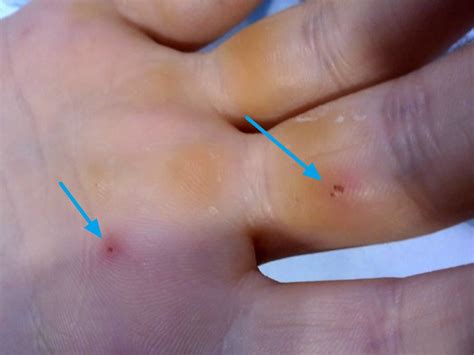 Osler Nodes Janeway Lesions And Splinter Hemorrhages