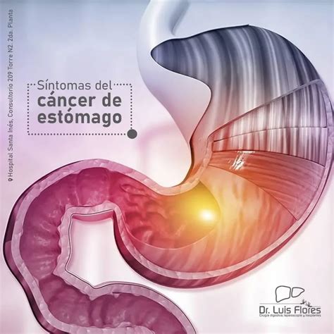Cáncer De Estómago Síntomas Diagnóstico Y Tratamiento Doctor Luis