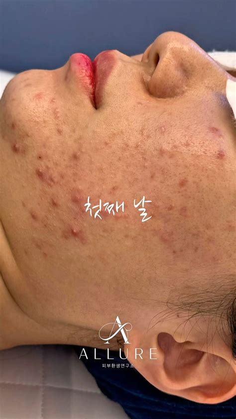 🥇안산 슈퍼젝션 여드름 전문 대표원장 황정하 40대 직장인 탄력저하 모공확장 여드름 및 흉터까지 복합적인 피부 고민을 가지고 알루어를 방문해 주신 고객님 1