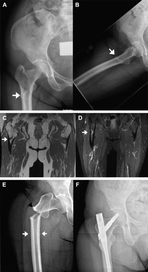 Bisphosphonate Therapy And Atypical Fractures Musculoskeletal Key