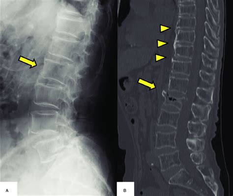 A Representative Case Of A Nonfused Segment Fracture In The Diffuse