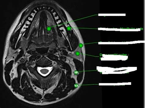 Neck Nodes 5 Diagram Quizlet