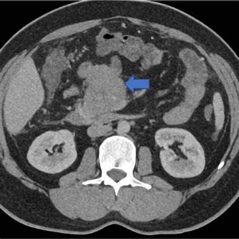 The Initial Ct Scan Showing Aggressive Malignant Process In Middle