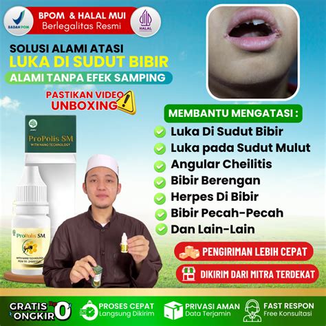 Jual Obat Tetes Oles Luka Di Sudut Bibir Obat Pinggir Bibir Luka Obat
