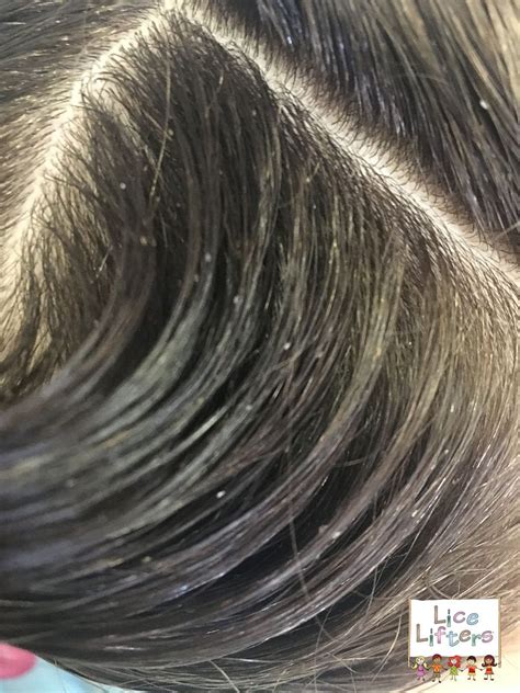Pictures Of Lice Eggs Porn Hub Sex
