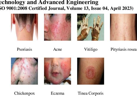 Classification Of Skin Disease Using Transfer Learning In Convolutional Neural Networks Paper