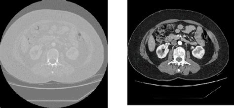 on the left ct scan with a predetermined fixed scaling factor on the