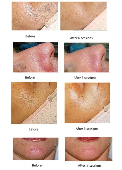 Pores Tightening Reducing The Size Of Skin Pores Canadian Optic Laser Rejuvenation Center