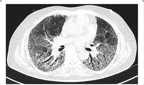 Ct Scan Lung Window Showing Honeycombing With Traction Broncheictasis Download Scientific Diagram