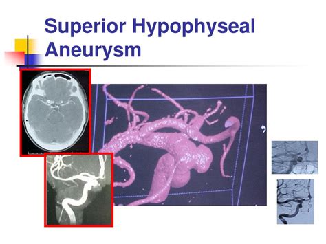 Ppt Surgical Anatomy Of The Paraclinoid Region Lessons From Many
