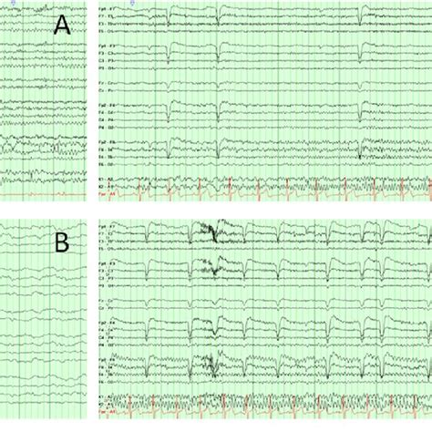 Examples Of Eeg Abnormalities A Focal Right Temporal Slowing Maximal