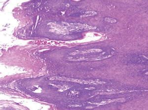 Focal Epithelial Hyperplasia Hecks Disease