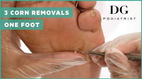 How To Remove Old Corns On Toes At Madison Calder Blog