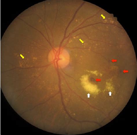 Figure 1 From Idiopathic Polypoidal Choroidal Vasculopathy In Thai Patients With Clinical And