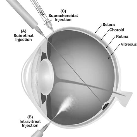 Routes Of Administration For Retinal Gene Delivery A Subretinal B Download Scientific
