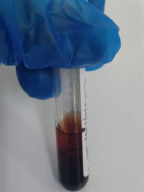 Hemolysed Rmedlabprofessionals