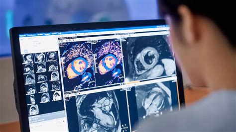 Compressed Sense Clinical Cardiac Mri Philips