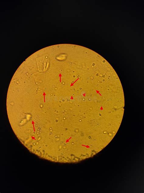 Beeld Van Urine Onder Microscoop Stock Afbeelding Image Of Urine Gegevens 47023153