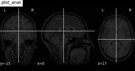 7 Plotting Brain Images Nilearn