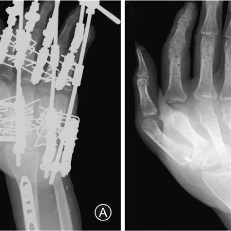 Radiographs Showing The Metacarpophalangeal Joints Fixed With Block