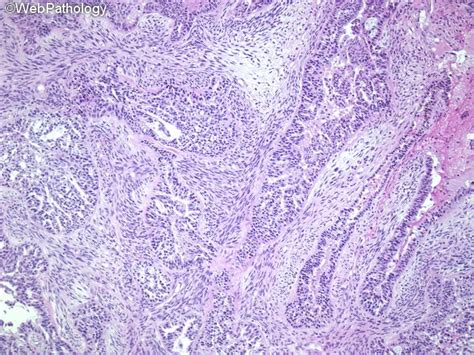 Synovial Sarcoma Classification