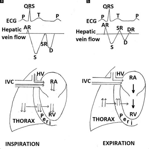 Hepatic Vein Doppler Showing Effect Of Expiration Exp And Inspiration Download Scientific