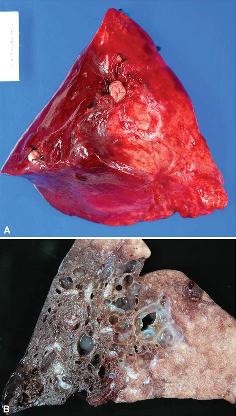 Developmental And Pediatric Lung Disease Clinical Tree