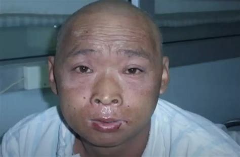 Horrifying Story Of ‘radioactive Man Who Suffered One Of The Most