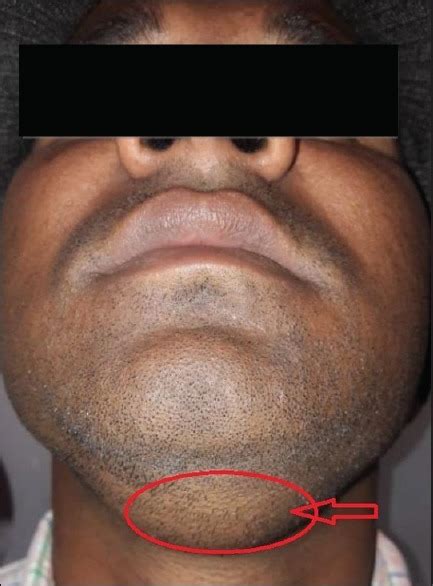 Double Chin Or Swelling Medizzy Journal