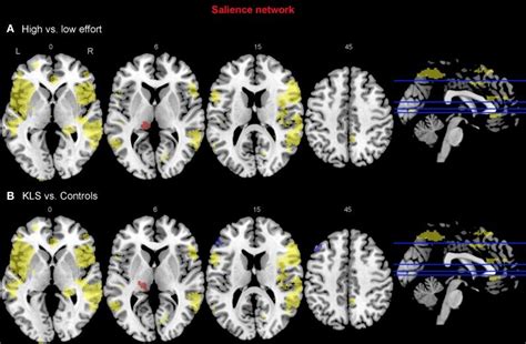 Functional Connectivity In The Salience Network The Images Show The Download Scientific
