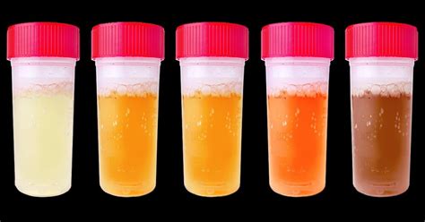 7 ფაქტი რასაც თქვენი შარდი განიშნებთ ჯანმრთელობის შესახებ