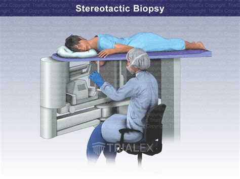 Stereotactic Biopsy Trialquest Inc