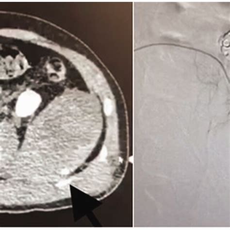 Imaging Results From Patient 2 A Site Of Contrast Extravasation In Download Scientific