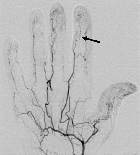 Corkscrew Collaterals In Raynauds Syndrome Bmj Case Reports