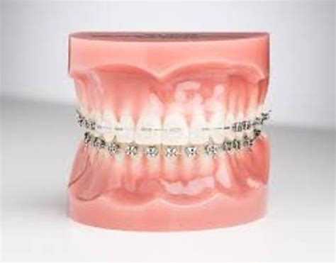 10 Facts About Braces Fact File
