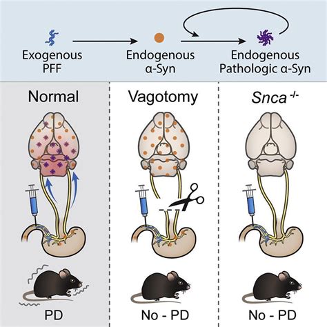 Propagation Of α Synuclein From The Gut To Brain New Causation For Parkinsons Disease