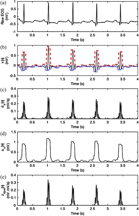 Figure From QRS Detection Algorithm For Telehealth Electrocardiogram Recordings Semantic Scholar
