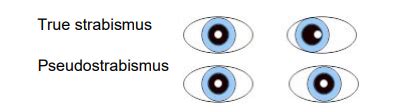 Pseudostrabismus University Hospitals Sussex Nhs Foundation Trust