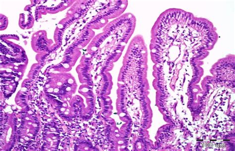 A Histopathological Examination Marsh Iiia Stage Lesions He X10 Download Scientific Diagram