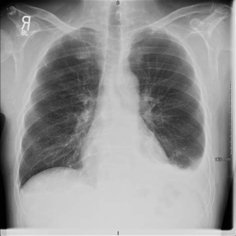 Eosinophilic Pleural Effusion What Does It Mean And What Do I Do Now University Of Maryland