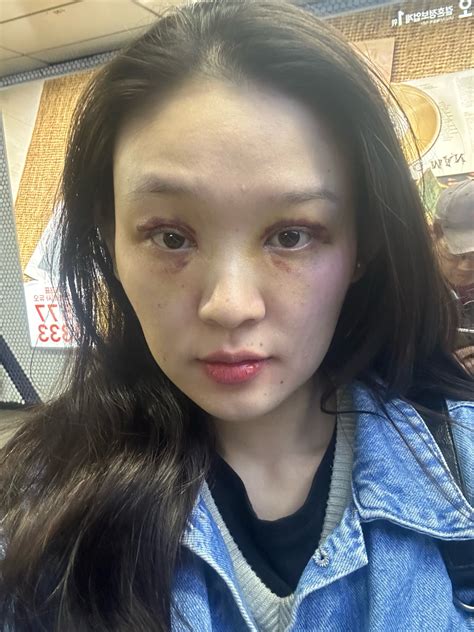 의사에게 물어보세요 내 눈의 가장 높은 강남언니 1등 성형수술and피부시술 정보앱