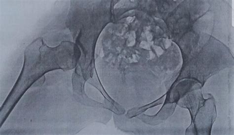 I Need Your Urgent Support For My Hip Abscess Treatment Ketto