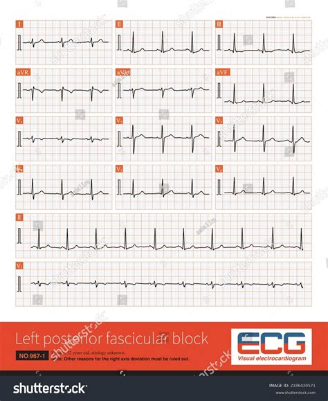 During Left Posterior Fascicular Block Ecg Stock Illustration