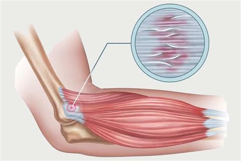 Lateral Epicondylitis Tennis Elbow — Jonathan Koscso Md