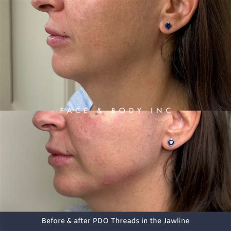 Pdo Threads Pdo Thread Lift Perth Face And Body Inc