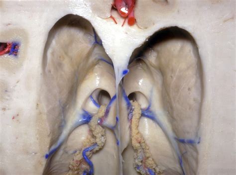 Anterior Horn And Body Of Lateral Ventricle Neuroanatomy The