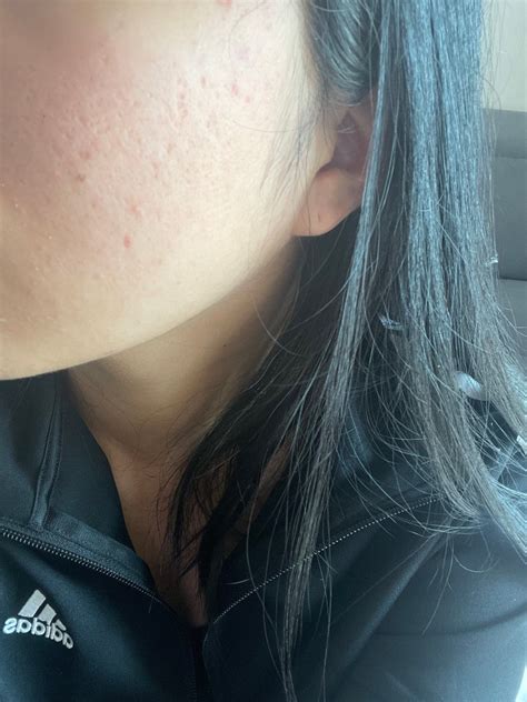 여드름 곰보피부 질문 지식in