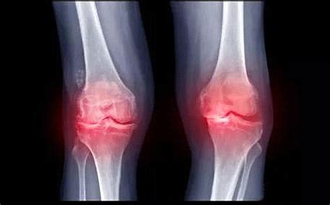 类风湿性关节炎患者，能不能做人工膝关节置换，会有什么风险？ 知乎