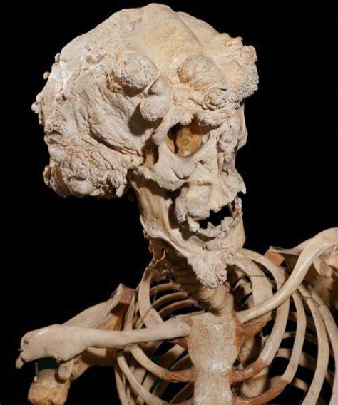 Lv 1 신경섬유종 환자의 유골혐오주의 인스티즈instiz 오싹공포 카테고리