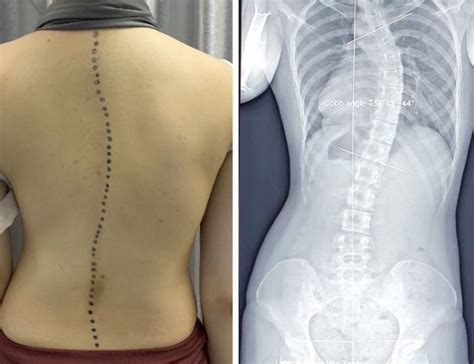 Cột Sống Cong Chữ C Vẹo Chữ S ở Lứa Tuổi Học đường